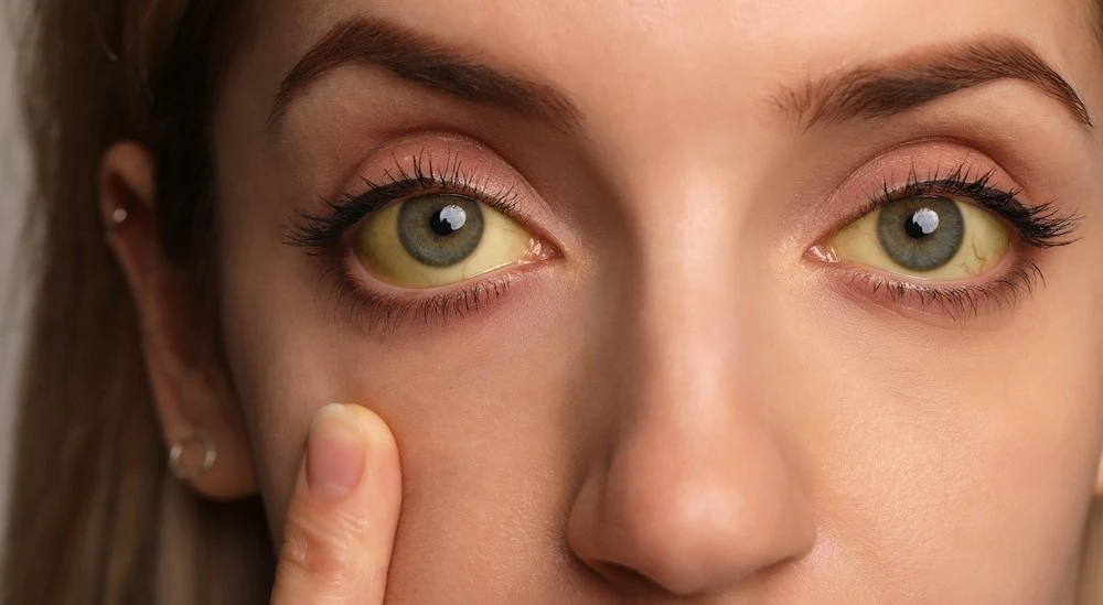 L'ittero: significato, cause e trattamenti - Santagostino Magazine