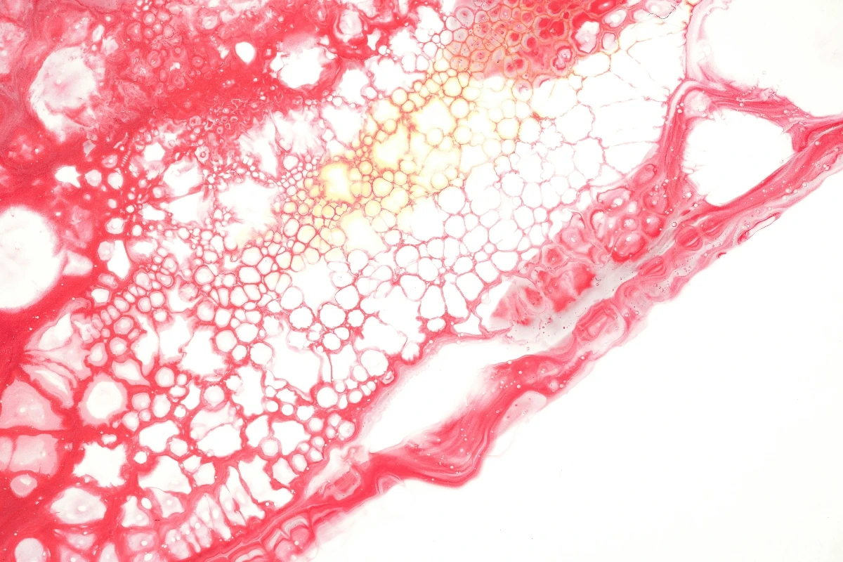 Anemia microcitica (microcitosi): come riconoscerla e trattarla ...