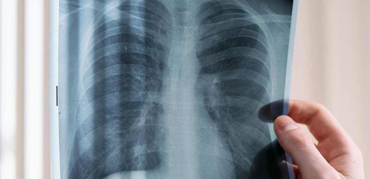 Fibrosi polmonare: cos'è, come riconoscerla e curarla - Santagostino ...