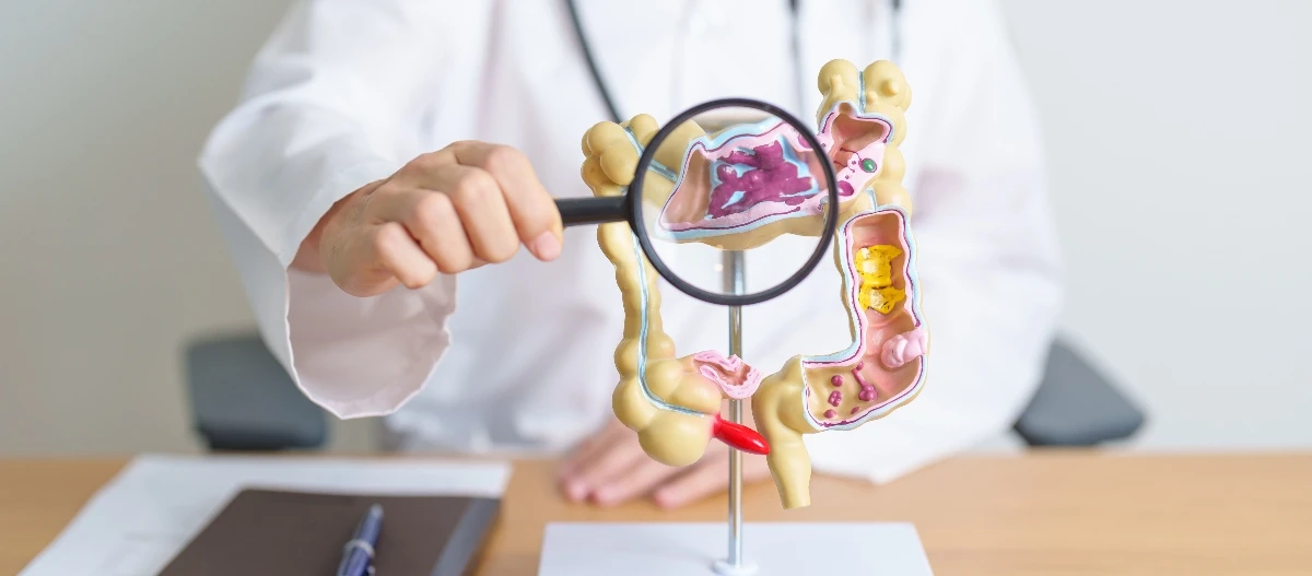 Il diverticolo di Meckel: sintomi e trattamenti - Santagostino Magazine