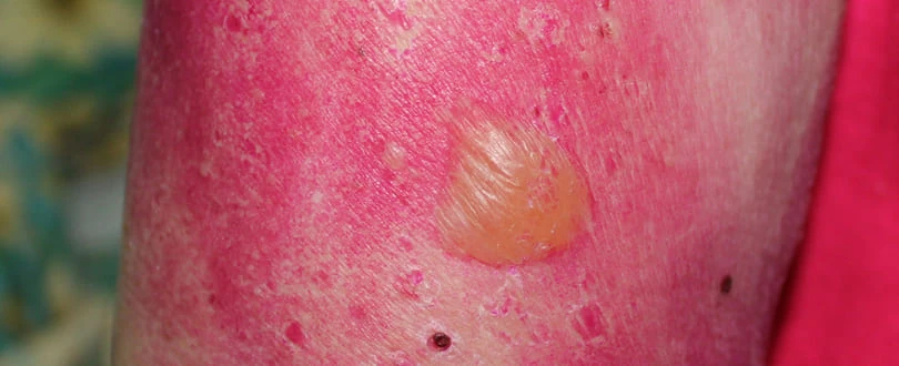 Pemfigoide bolloso. Sintomi e cura | Santagostino