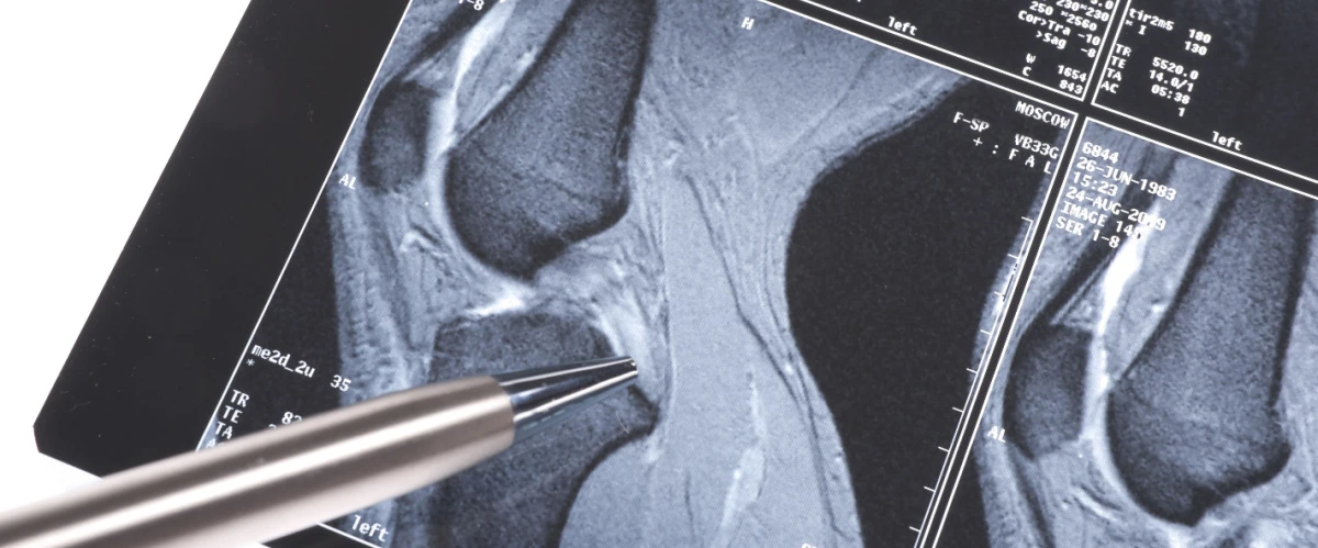 Legamento crociato rotto: sintomi, cause e trattamenti - Santagostino ...