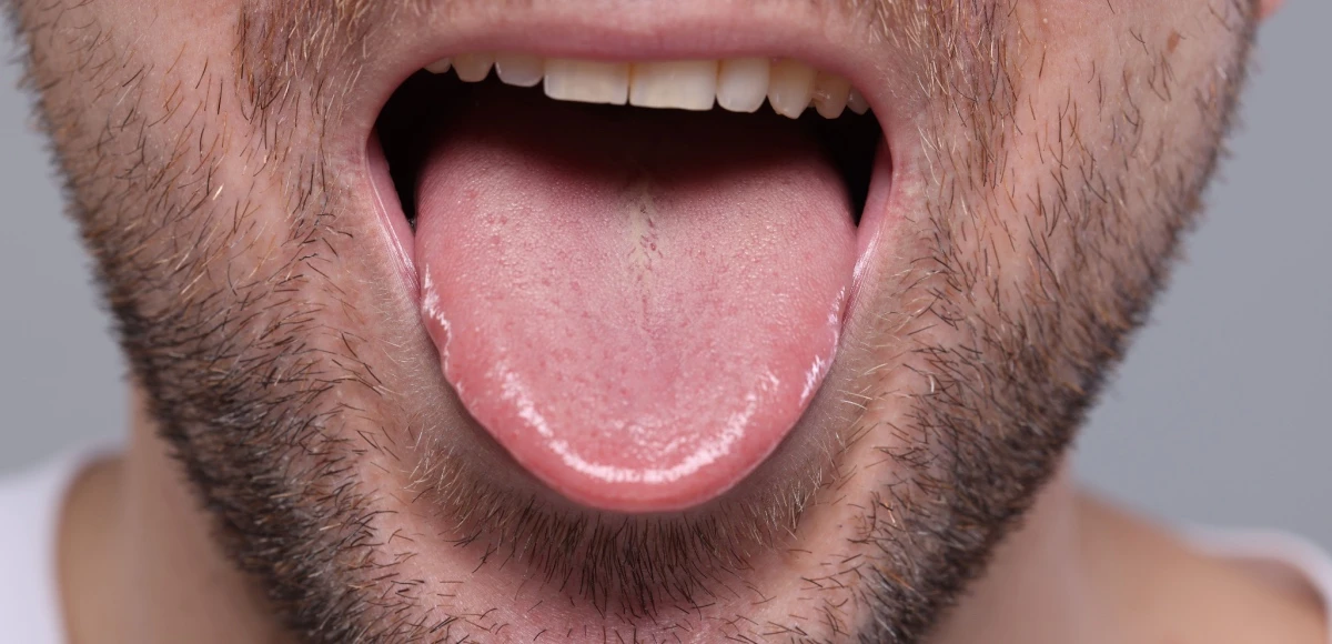 La macroglossia o lingua grossa: cos’è e quali sono le cause ...