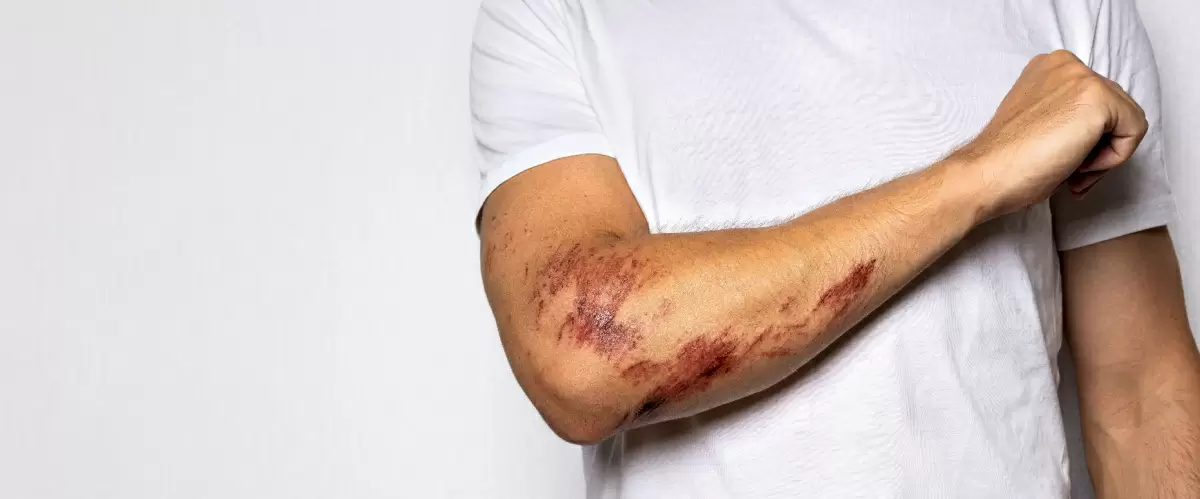 Escoriazioni della pelle. Tipi, rimedi, cosa mettere - Santagostino ...